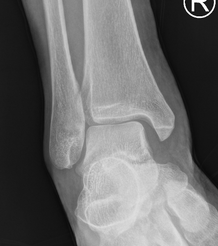 Deltoid ligament injury | The Bone School